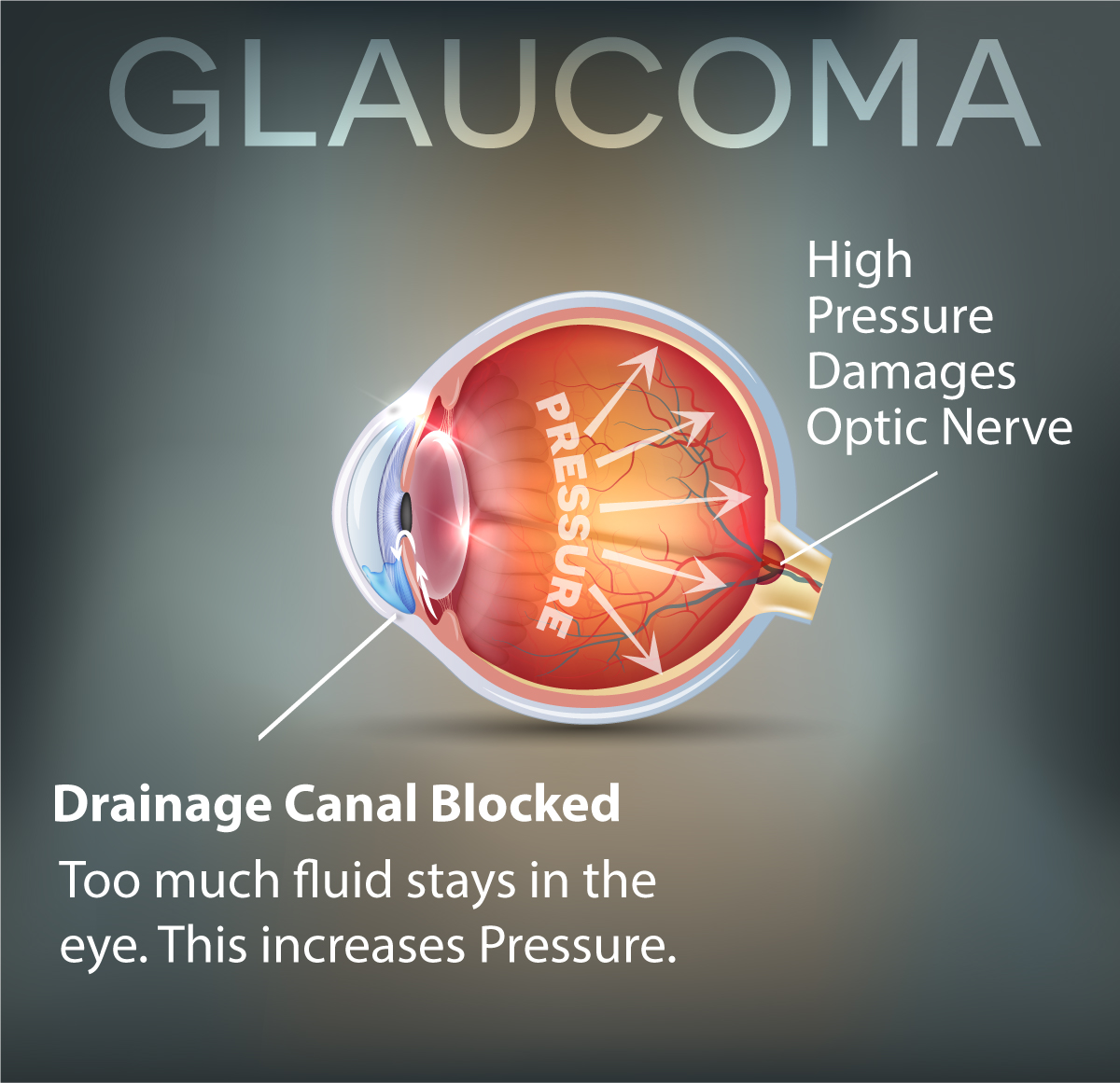 Glaucoma and Treatments In Michigan - Grosinger, Spigelman & Grey Glaucoma and Treatments In Michigan - Grosinger, Spigelman & Grey